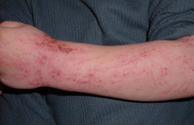 Pediatric Eczema – Fairfield Dermatology