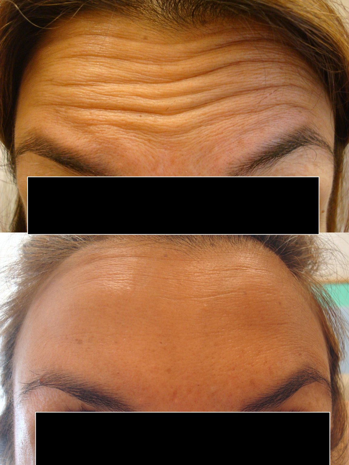 Botox-upper-forehead | Fairfield Dermatology