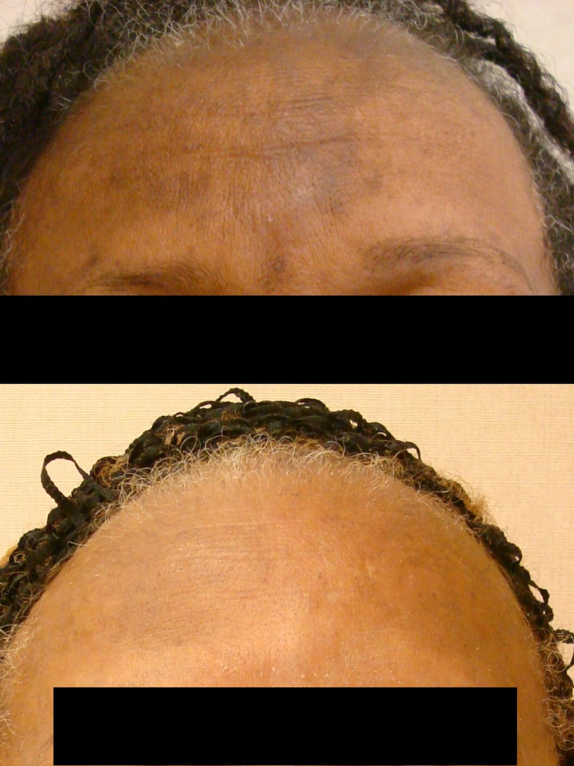 Chemical-peel-post-inflammatory-hyperpigmentation | Fairfield Dermatology