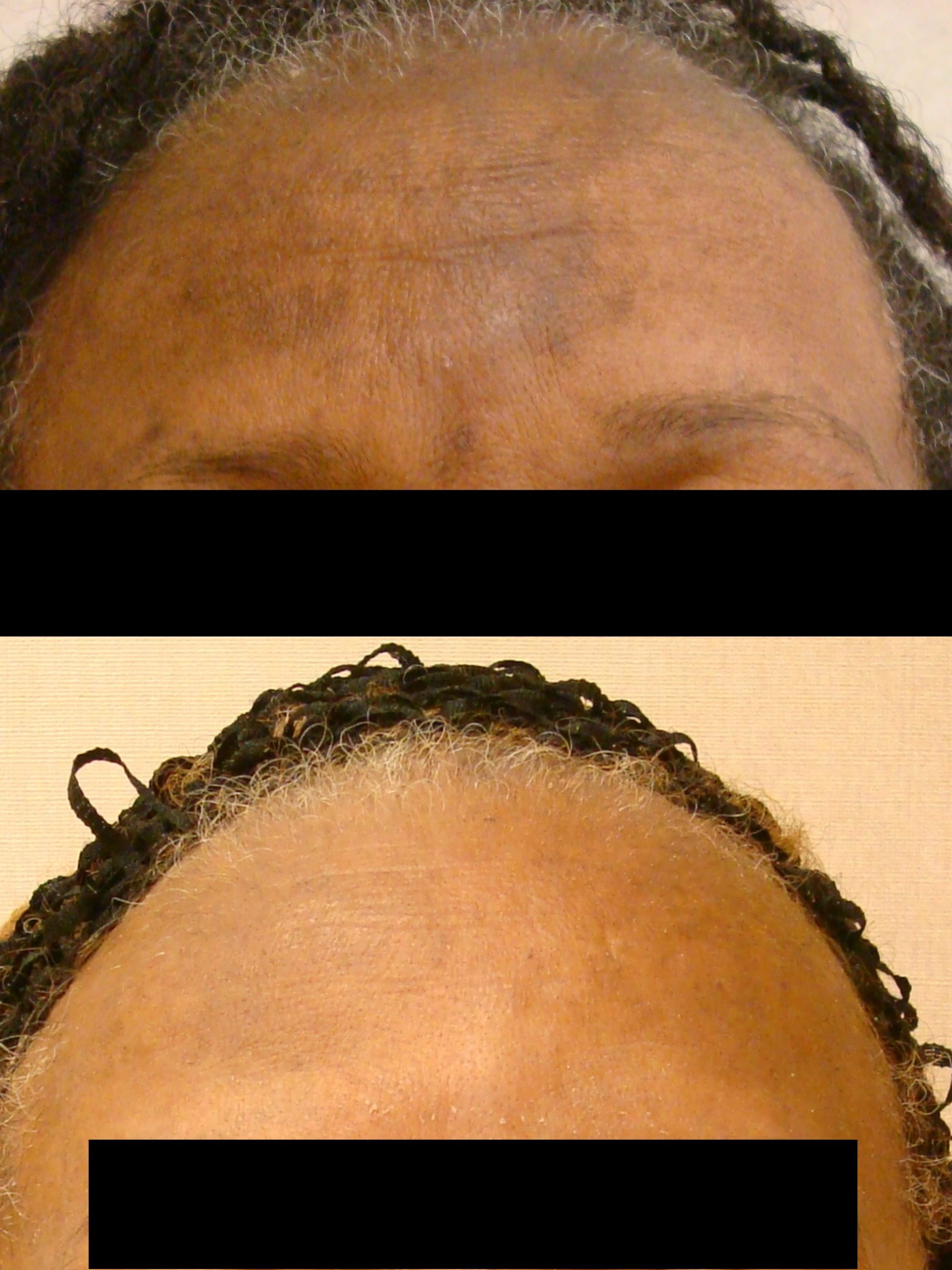 Chemical peel post inflammatory hyperpigmentation Fairfield Dermatology Chemical peel post inflammatory hyperpigmentation Fairfield Dermatology