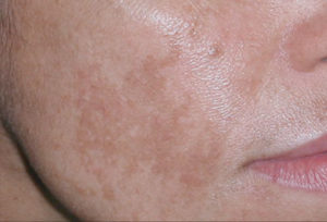 Melasma and Pigmentation disorders | Fairfield Dermatology