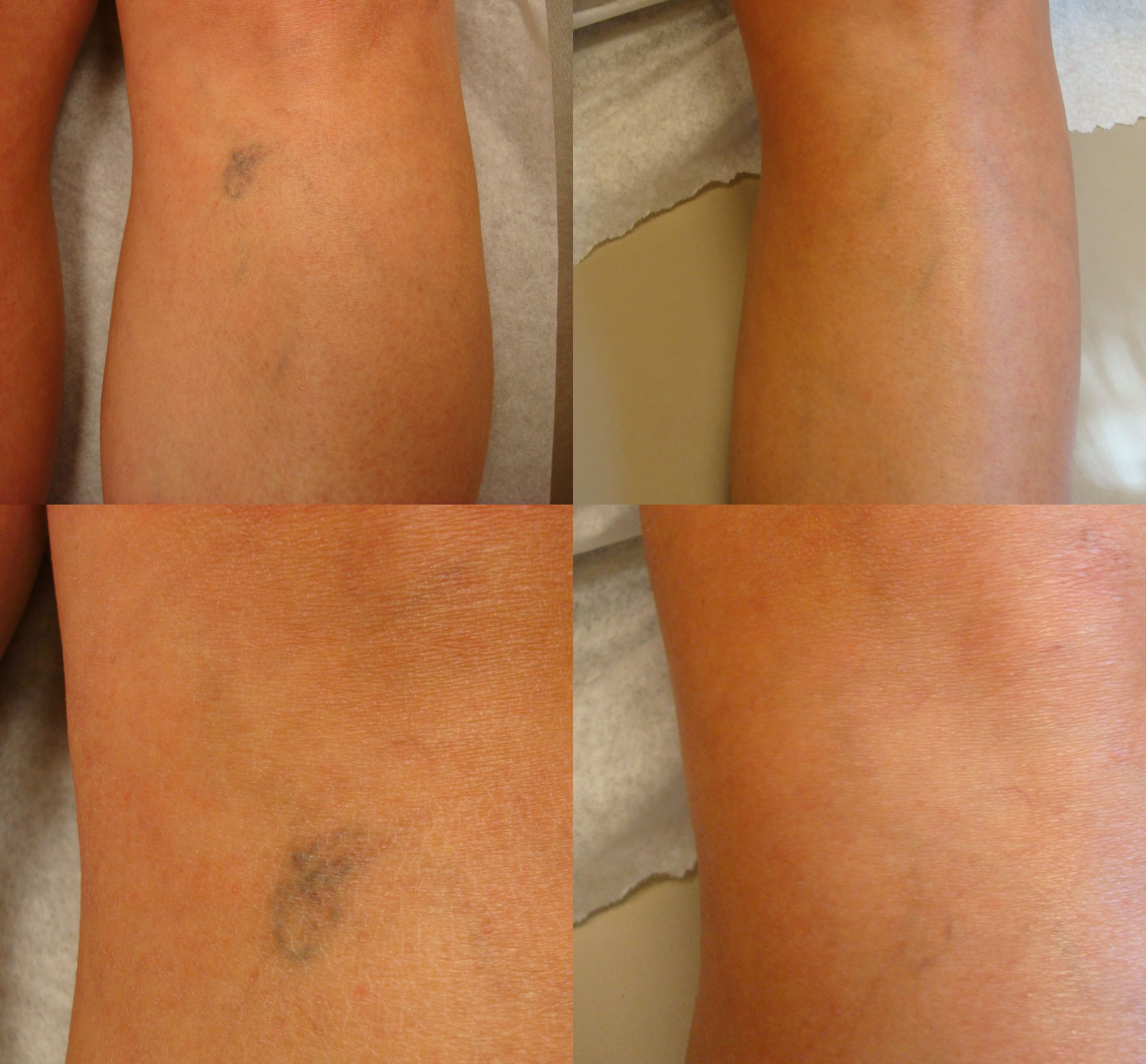 sclerotherapy | Fairfield Dermatology