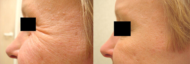 Botox | Fairfield Dermatology