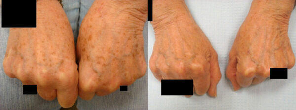 Brown Spot Removal | Fairfield Dermatology