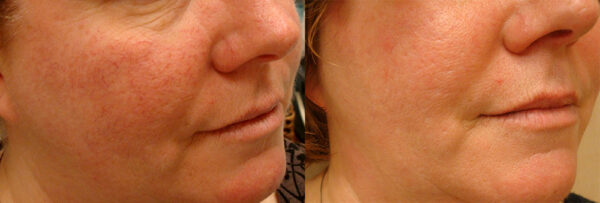 Facial Redness | Fairfield Dermatology